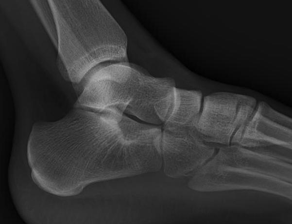 Chopart Dislocation | The Bone School